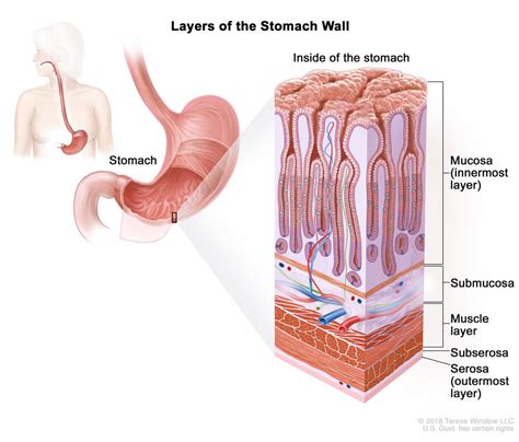 Stages Of Stomach Cancer Nci