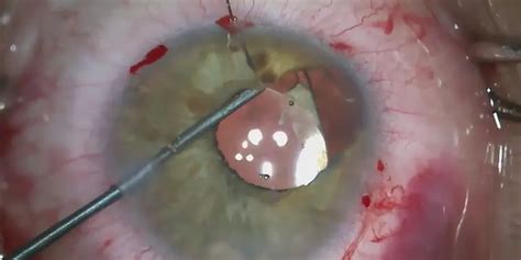 Repair Of Congenital Iris Coloboma But Substantially Improved Using