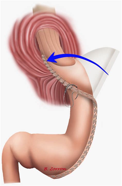 Laparoscopic Partial Gastrectomy Cpt Code