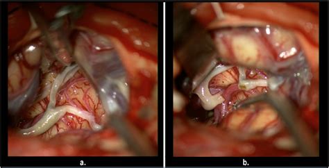 Figure Showing The Peroperative Findings After Pterional Craniotomy And Download Scientific