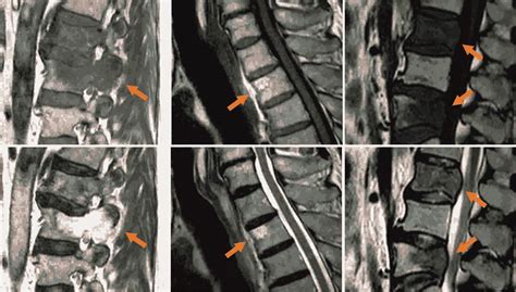 Spinal Metastases Segmentation In Mr Imaging Using Deep Convolutional Neural Networks Deepai