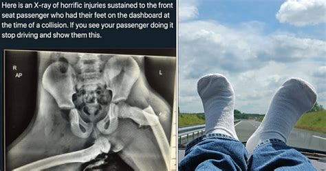 Police Warn Against Feet On Dashboard After Woman S Life Changing Injuries
