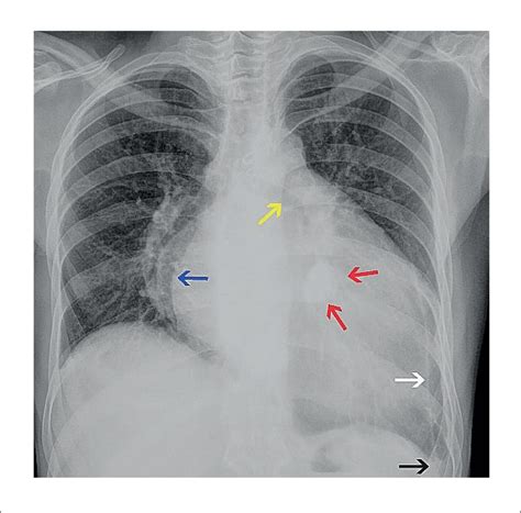 Caseous Calcification Of The Mitral Annulus A Post Heart Transplant