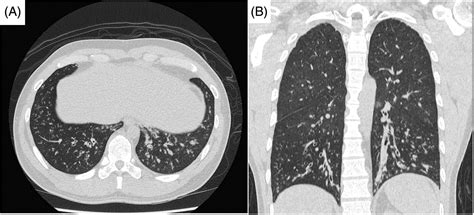Respirology Case Reports Vol 12 No 11