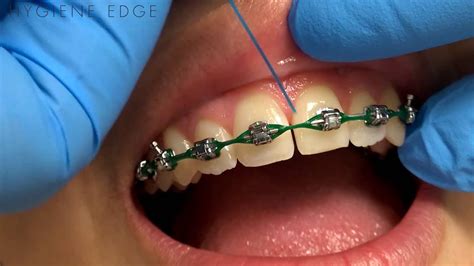 How To Floss Teeth With Thread At Gladys Roy Blog