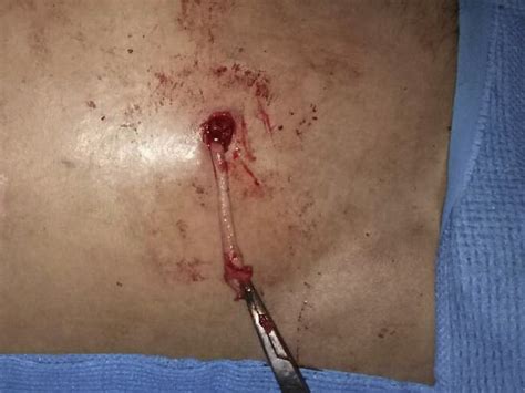 Appendix Removal Through The Drain Site Orifice Download Scientific