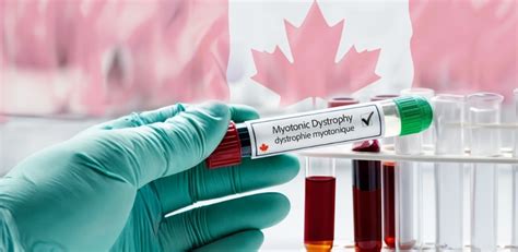 Improving Access To Genetic Testing For Myotonic Dystrophy Muscular