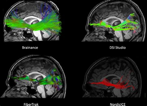 Reconstruction Of The Left Inferior Fronto Occipital Fasciculus Download Scientific Diagram