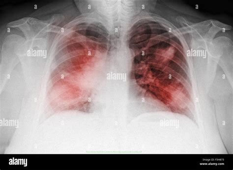 Chest X Ray Of A 44 Year Old Woman Smoker Pa View Showing Diffuse Interstitial Infiltrates
