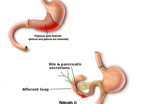 Afferent Loop Syndrome Md Searchlight