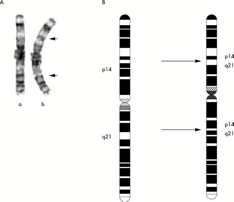 A Novel Pericentric Inversion Of Chromosome 3 Cosegregates With A