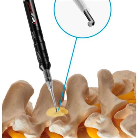 Illustration Showing The Use Of The Ultrasonic Bone Scalpel Ubs Hook Download Scientific