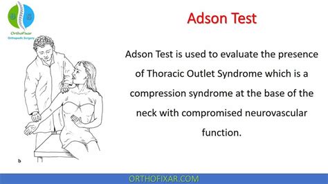 Adson Test For Diagnosing Thoracic Outlet Syndrome Artofit