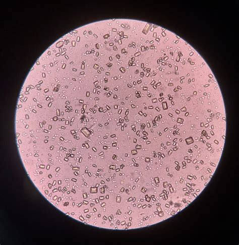 Het Vinden Van Urineanalyse Met Microscoop Toont Kristalbacteriën En