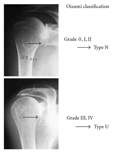 Radiological Classification Of Glenoid Deformity In Rheumatoid Arthritis Abstract Europe Pmc