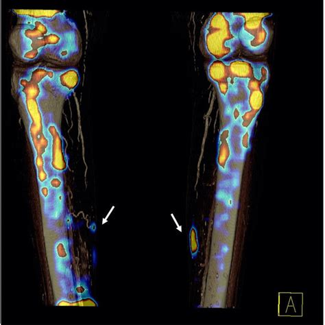 Bone Spectct With 3d Reconstruction Download Scientific Diagram