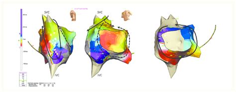 Left Rao View Of Ra With Activation Map Of A Macroreentrant Download Scientific Diagram