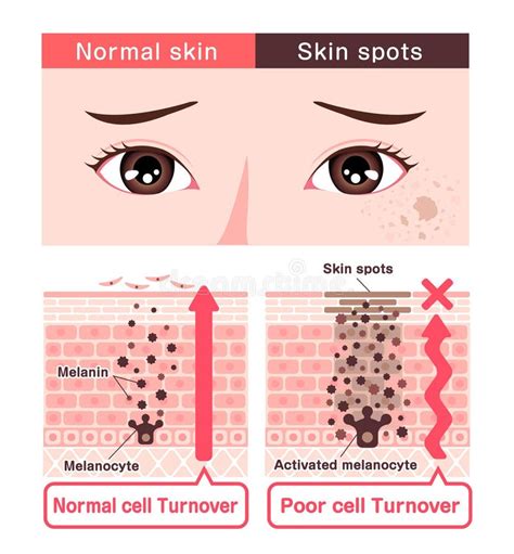 Illustration Of How Skin Spots Hyperpigmentation Are Created Stock