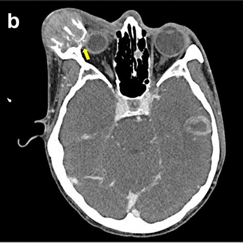 A B Large Facial Swelling On The Right Zygomatic Region With