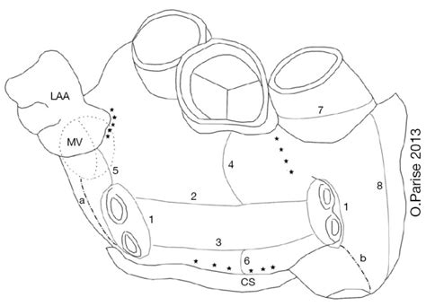 Hybrid Approaches In Atrial Fibrillation Ablation Why Where And Who Pmc
