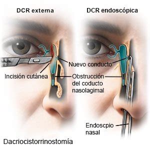 Dcr Dacriocistorrinostomía Lo Que Necesita Saber