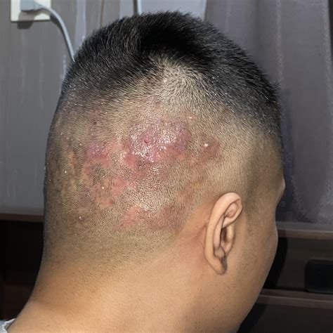 Scalp Folliculitis Flare Ups Rfolliculitis