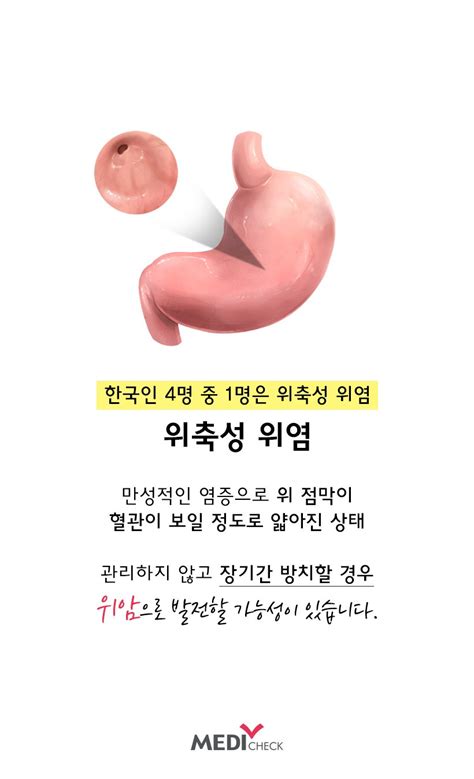 위축성 위염 진단하는 위내시경 조직검사 네이버 포스트