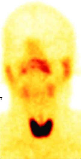 Follow Up 99m Technetium Thyroid Scan Revealing Complete Recovery Of