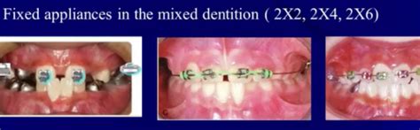 Ortho Exam Flashcards Quizlet