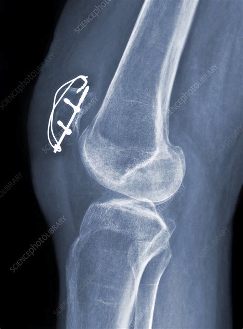 Internal Fixation Of The Patella Stock Image C0034820 Science