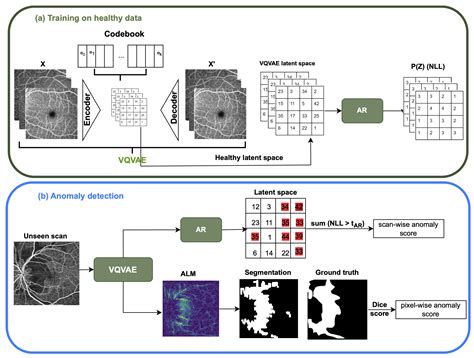 Anomaly Detection In Optical Coherence Tomography Angiography Octa