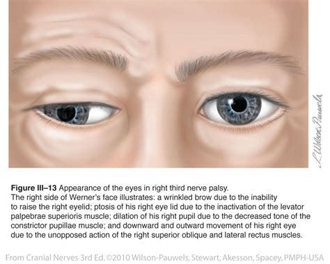9 Third Nerve Palsy Ideas To Save Today Nerve Palsy Cranial Nerves