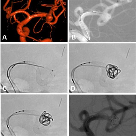 A Incidental Broad Based Aneurysm Of The Left Mca In A Female Patient