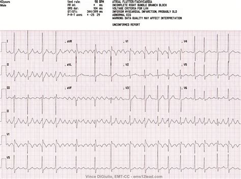 A Flutter Ekg Hetybee