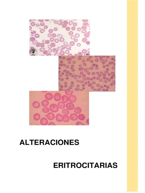 Alteraciones Eritrocitarias Pdf Glóbulo Rojo Anemia
