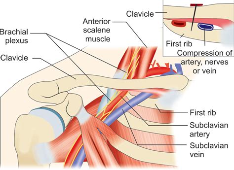 Proximal Clavicle Fracture