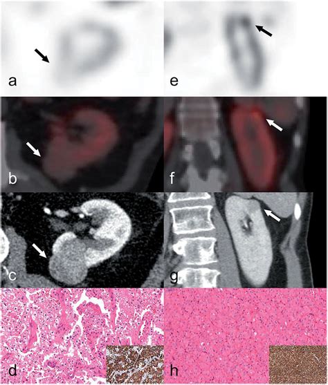 A Sestamibi Negative And A Sestamibi Positive Chrcc From 2 Different Download Scientific