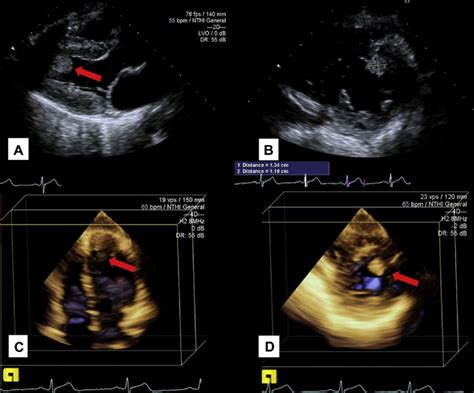 E Transthoracic Echocardiography Demonstrates An Oval Homogeneous