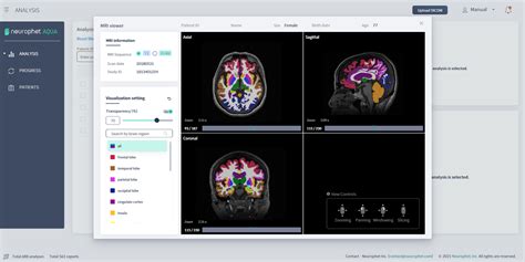 Deep Learning Segmentation Offers Reliable Alzheimers Disease Subtype