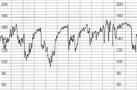 Figure1 Cardiotocographic Tracing Showed Atypical Variable
