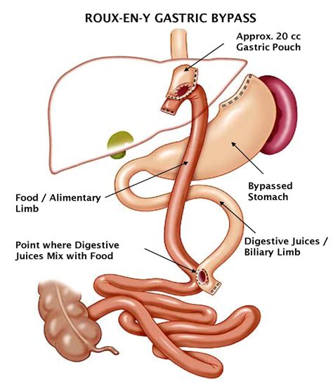 Roux En Y Gastric Bypass