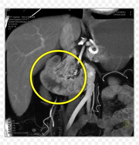 Computed Tomography Radiology Polyp Duodenum Large Intestine Png