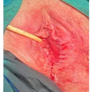 Repair Of The Surgical Wound With Single Sutures Download Scientific Diagram