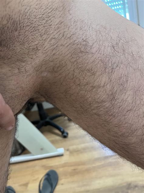 Intertrigo R Dermatologyquestions