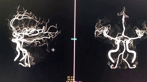 Cerebral Mra