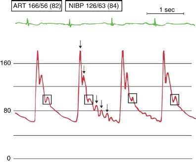 Arterial Line Waveform Matching Flashcards Quizlet