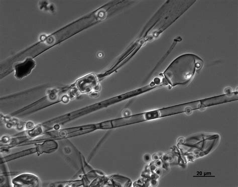 Mucor Racemosus Culture Infection Causes And Treatment