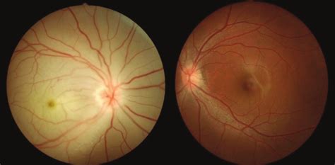 Fundus Examination Shows Diffuse Whitening Retinal Edema Optic Disc