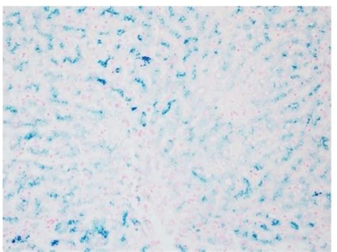 Path Lab Liver Flashcards Quizlet