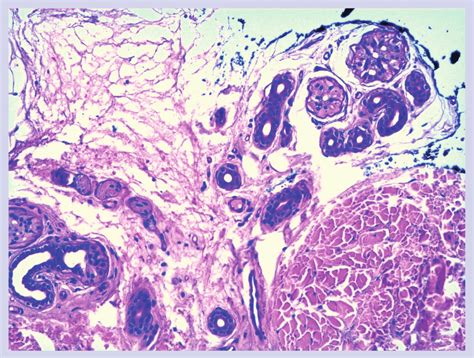 Histopathology Of Aquagenic Keratoderma At The Dermo Hypodermal Download Scientific Diagram